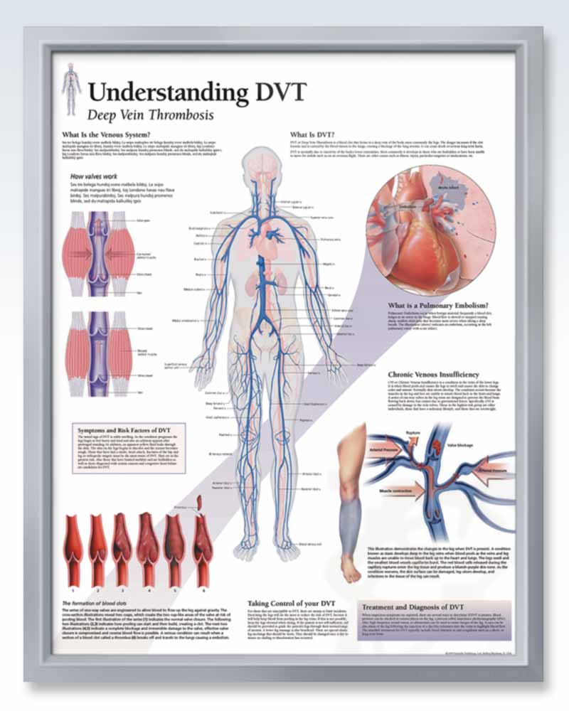 Understanding DVT Exam-Room Anatomy Poster | ClinicalPosters